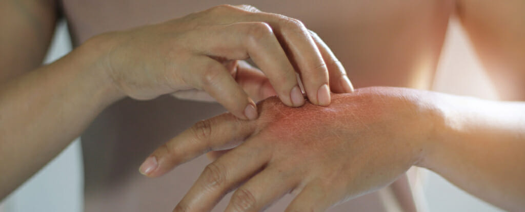The Truth about Nickel Allergies