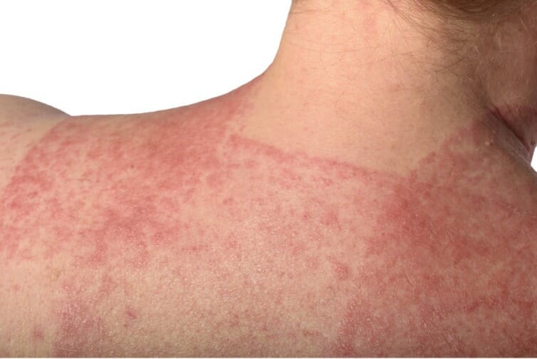 A Comprehensive Guide to Contact Dermatitis from Sunscreens: Causes ...